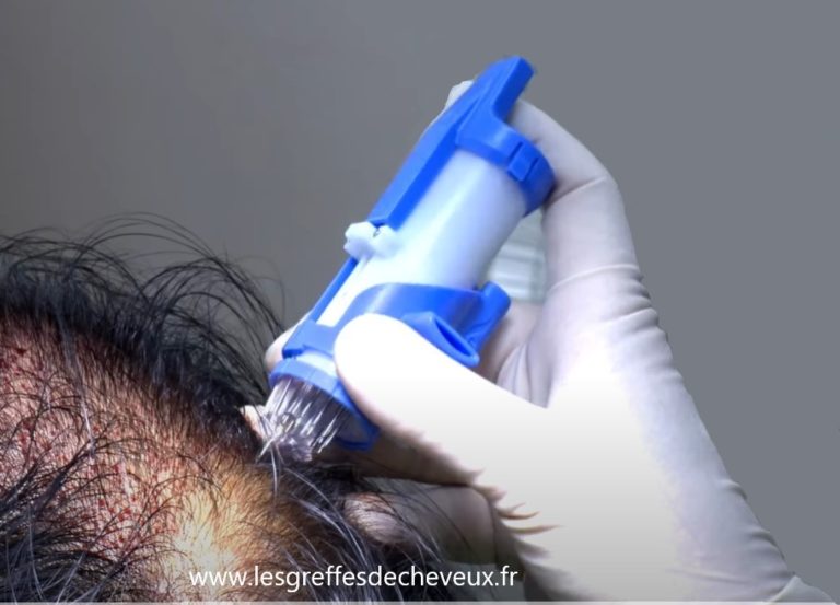 Injection de cheveux : quelle technique ? | Docteur Boudjema